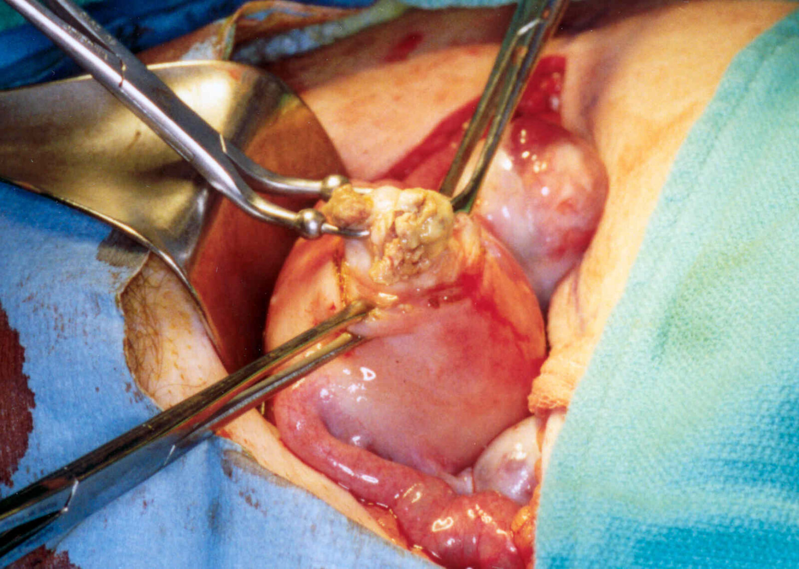 Open Myomectomy - Nashville Fertility