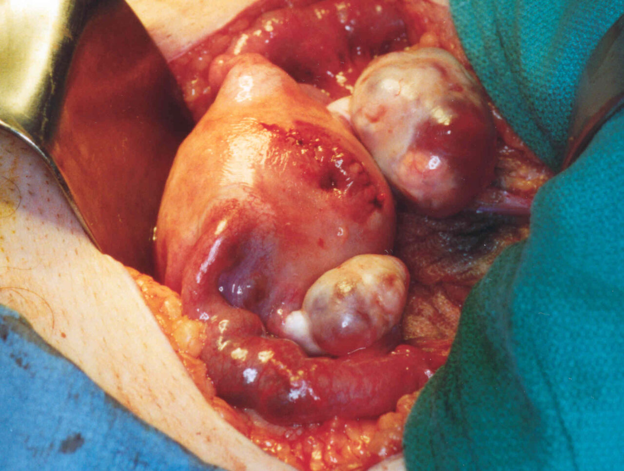 Open Myomectomy - Nashville Fertility